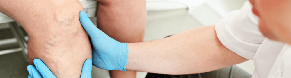 Trombose nas pernas: sintomas e tratamentos | Rede Américas