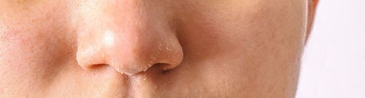 Câncer de pele no nariz: como identificar