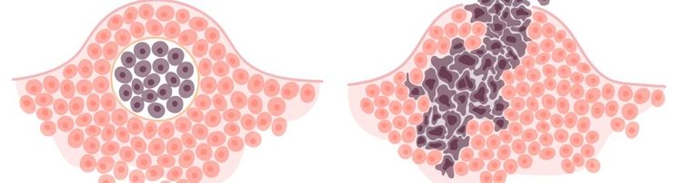 Qual a diferença entre câncer maligno e benigno?