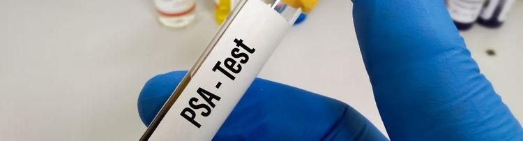 Exame de PSA: para que serve e quais são os níveis de referência