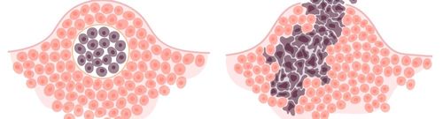 Qual a diferença entre câncer maligno e benigno?