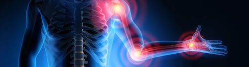 Câncer de medula óssea sintomas: conheça os principais sinais